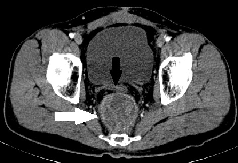 Asymptomatic Rectal Perforation After Radiation for Rectal Cancer: A ...